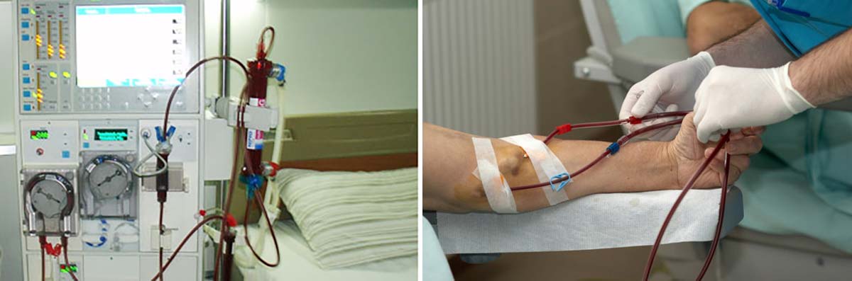 What Is Normal Blood Pressure for Dialysis Patients? - HPP LINES