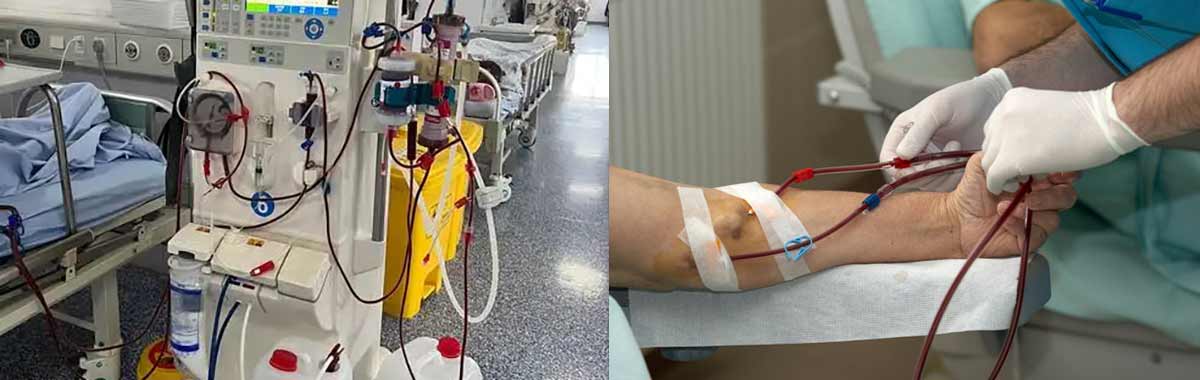 What Is Diffusion in Dialysis? - HPP LINES